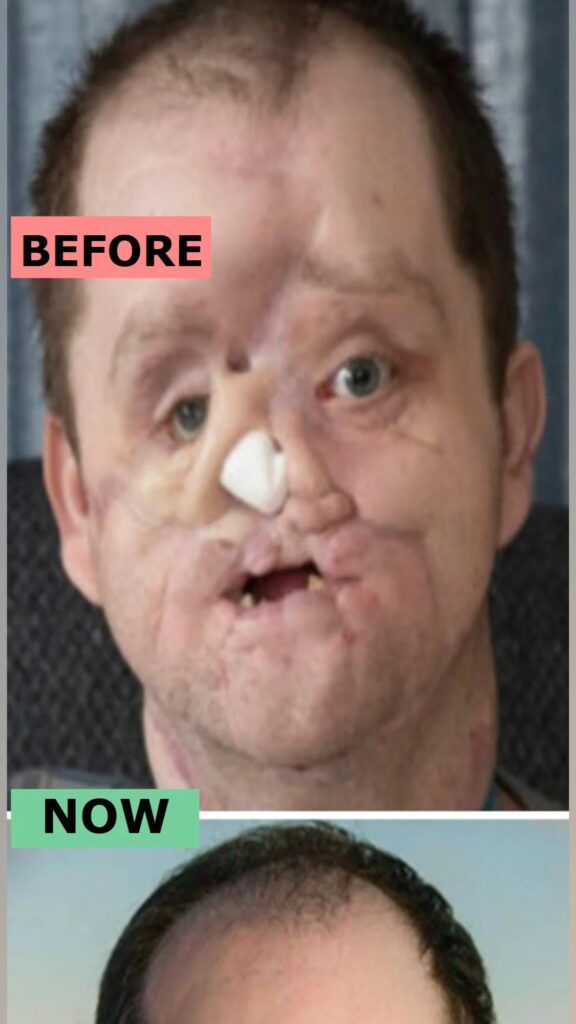 Before undergoing a 50-hour face transplant surgery, I was constantly ...